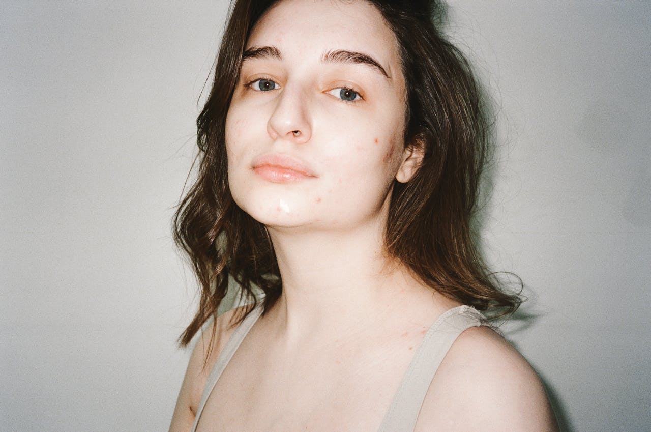 Love Pimple: Myth or Reality? Understanding Its Significance - Atchuup ...